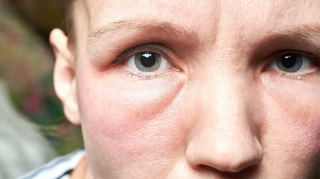 O que pode ser Rosto Inchado: Causas e Tratamentos | Cuidados Pela Vida